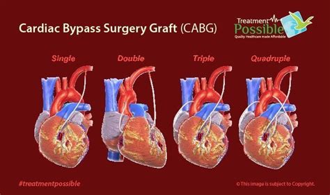Quadruple Bypass Surgery Statistics Outcomes Of Coronary Artery Bypass