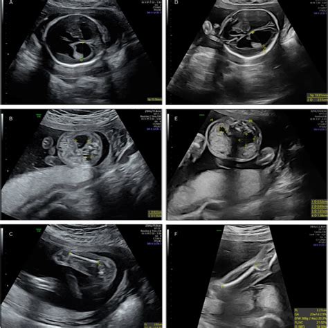 20 Week Anatomy Ultrasound Findings Compared To 22 Week Follow Up