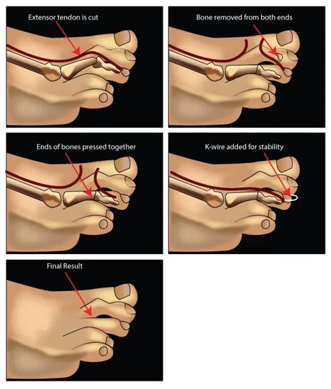 Hammertoe Surgical Correction