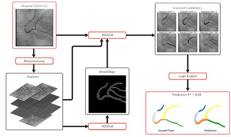 Automatic Coronary Anatomy Segmentation And Stenosis Detection From X Ray Coronary Angiography