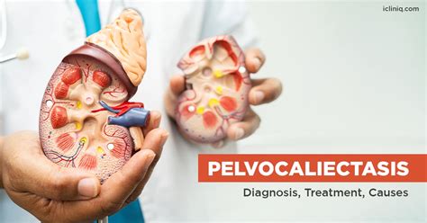 Icliniq Medical Conditions Pelvocaliectasis