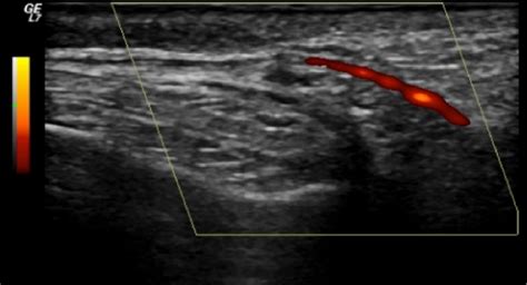 Figure 1 From Temporal Arteries Doppler Ultrassound For The Diagnosis Of Giant Cell Arteritis