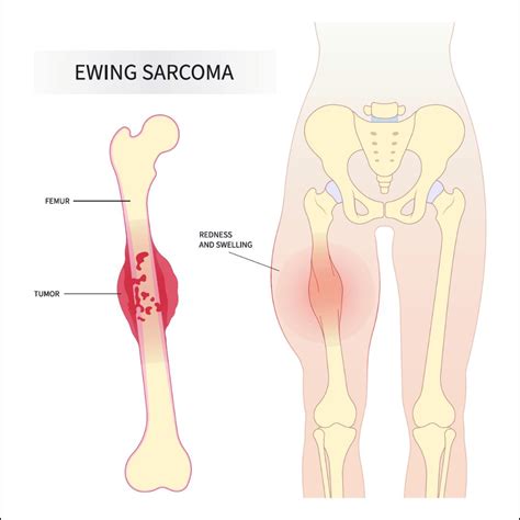 Ewing Sarcoma Causes Risk Factors Symptoms Treatment