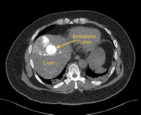 Laparoscopic Central Hepatectomy Using Dual Staining Indocyanine Green Fluorescence Icg 52 Y O