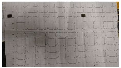 Acute Pericarditis Pptx