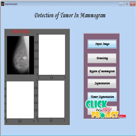 Detection Of Suspicious Lesions By Adaptive Thresholding Based On Multiresolution Analysis In