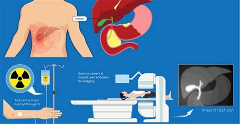 Hida Scan Reasons Preparation Procedure Results And Risks