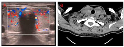 A Color Doppler Ultrasound Of The Thyroid Gland Showed Bilateral Download Scientific Diagram
