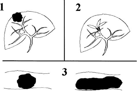 Intrahepatic Cholangiocarcinoma Macroscopic Type And Stage