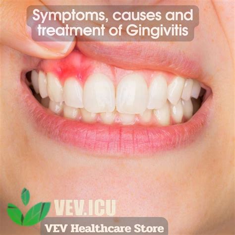 Symptoms Causes And Treatment Of Gingivitis