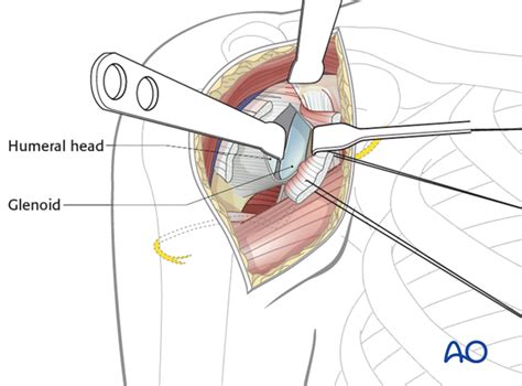 Deltopectoral Approach To The Scapula