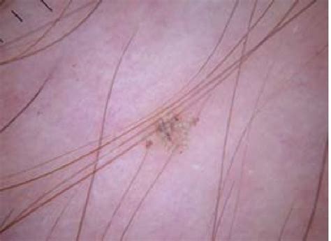 Pubic Lice Under A Microscope