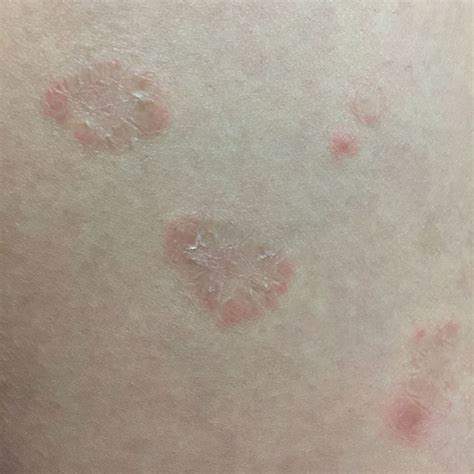 Лечение на розов лишей Снимки Дерматолог в гр София