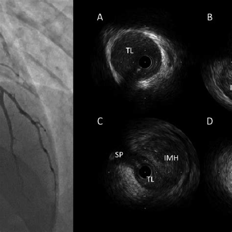 Representative Case Of Type 1 Spontaneous Coronary Artery Dissection