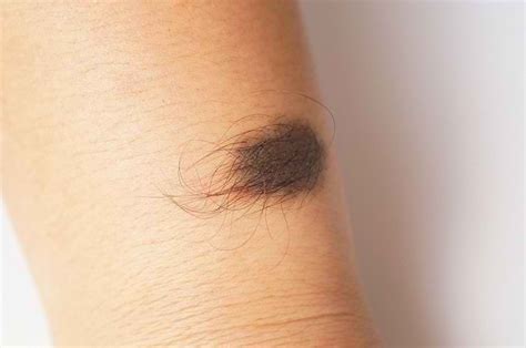 Mengenal Tompel Tanda Lahir Yang Umum Dijumpai Alodokter