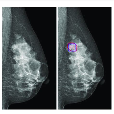 Pdf Classification Of Microcalcification Clusters Using Bilateral