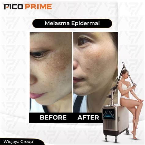Pico Laser Alat Treatment Terbaik Untuk Klinik Kecantikan Anda
