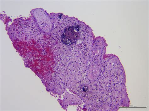 Xanthogranulomatous Pyelonephritis Gross Pathology
