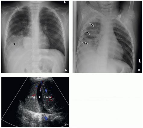 Pleura Radiology Key