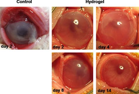 Outcomes Of Bacterial Inoculation After Standard Cataract Surgery In