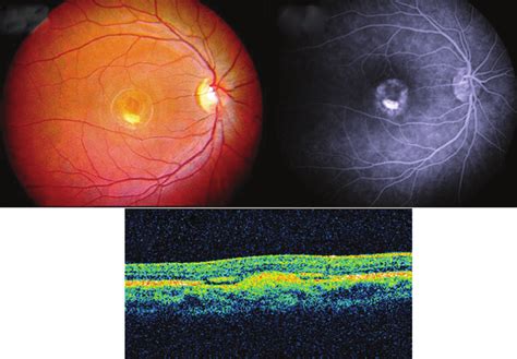 Six Weeks After The Second Injection Of Bevacizumab A Fundus Download Scientific Diagram