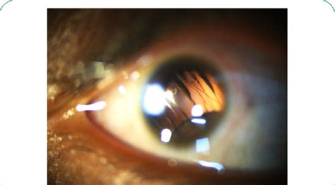 Shows A Microphthalmic Eye With Microcornea And Elongated Ciliary