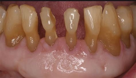 Immediate Tooth Replacement Therapy Itrt For Lower Incisors Southern