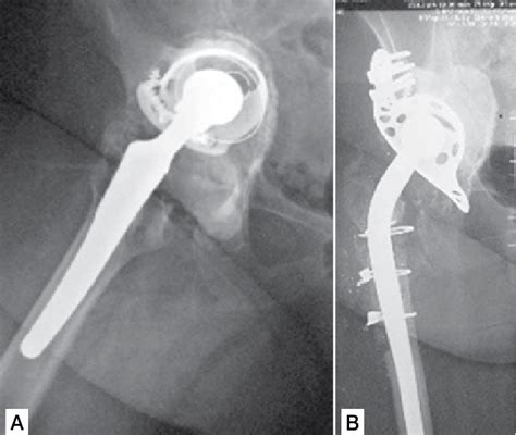 A Preoperative Acetabular Defect Paprosky Type 3 B B Five Years