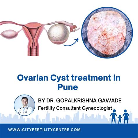 Ovarian Cyst Removal By Laparoscopic Surgery Dr Gopalkrishna Gawade