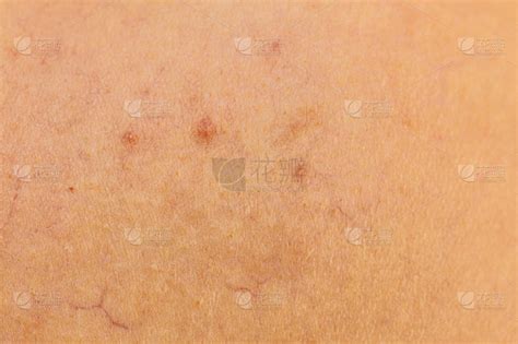 滑雪时毛细血管扩张，有红斑