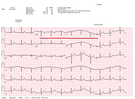 Are These The Pvcs Rpvcs
