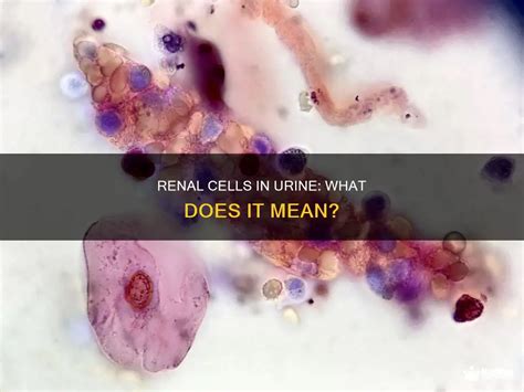 Renal Cells In Urine What Does It Mean Medshun