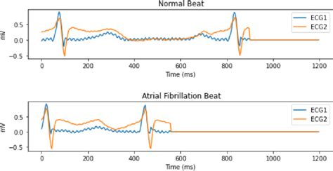 Figure 2 From Automated Atrial Fibrillation Classification Based On Denoising Stacked
