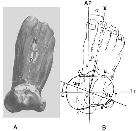 A Axial View Of The Tibia And Foot Alignment Of The