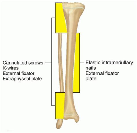 Pediatric Tibial Fractures Musculoskeletal Key