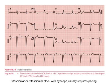 Axis Types Of Axis In Ecg And How To Interpret In Ecg Pptx