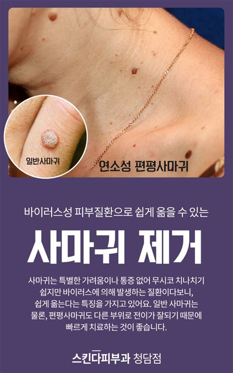 편평사마귀 피부과 치료의 초기 증상에 대해 알아보세요 이슈칼럼
