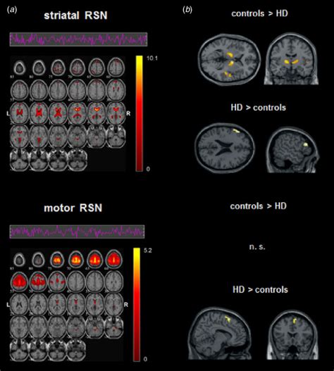 Striatal And Motor Resting State Network Rsn Functional Connectivity Download Scientific