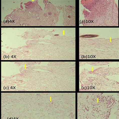 A Presence Of Massive Reactive Cells Yellow Arrows Beneath The
