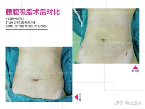 为什么很多人非要选择吸脂而不锻炼减肥呢 知乎