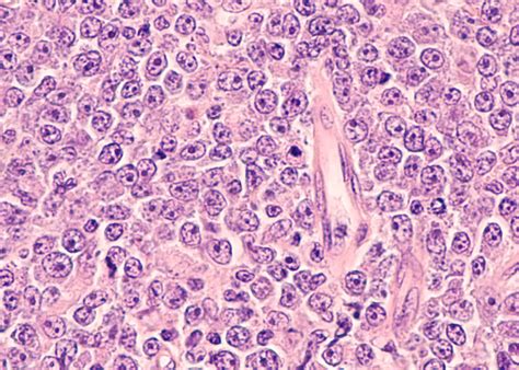 Lymphoma Treatment Burjeel Medical City Abu Dhabi