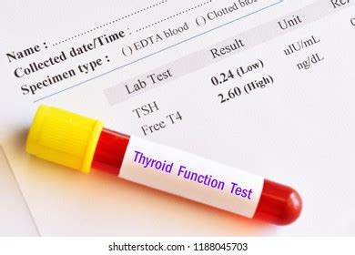 Hyperthyroidism Result Blood Sample Tube Stock Photo Shutterstock