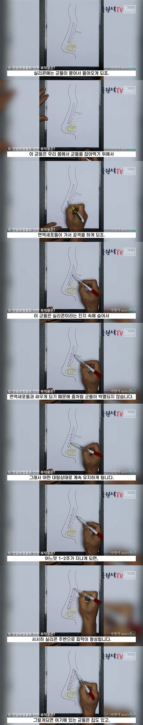 더쿠 코성형 부작용인 구축코의 발생과정과 원인