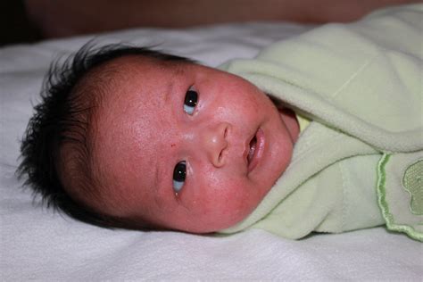 IMG 0773 From Neonatal Acne To Seborrheic Dermatitis I Re Flickr