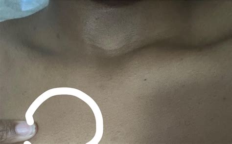 Raised Hard Bump On Upper Chest R Diagnoseme