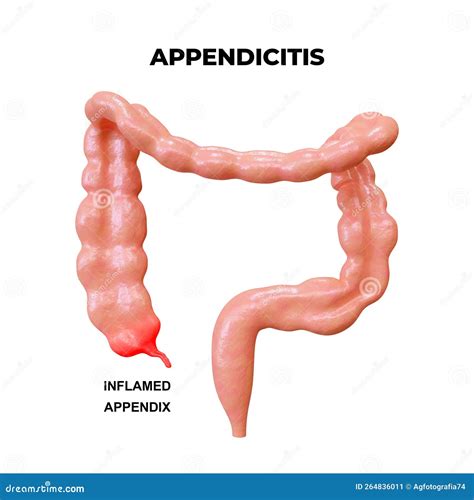 Appendicitis Consists Of Inflammation And Infection Of The Appendix A Small Segment That