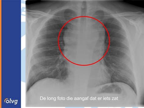 Lung Scans Ppt