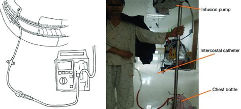 With The Help Of Continuous Intercostal Nerve Block Patients Could Download Scientific Diagram
