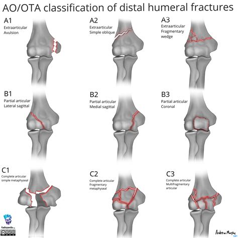 Ao Classification Of Humeral Shaft Fractures At Steven Obrien Blog