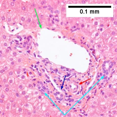 Steatohepatitis Libre Pathology